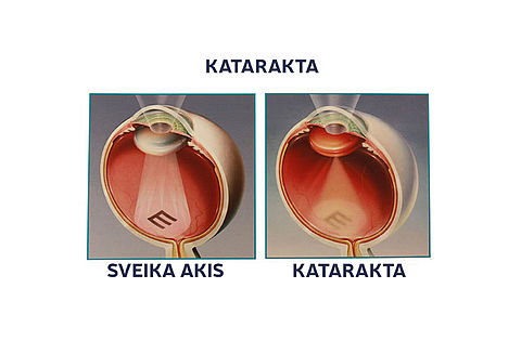 Katarakta | Bausch + Lomb